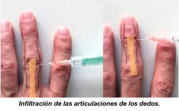 Artrosis de los dedos (nódulos de Bouchard y Heberden) - Synergia