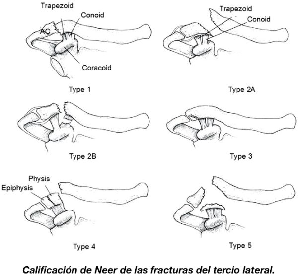 Fracturas de clavícula - Synergia