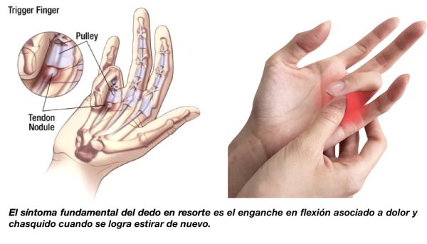 Dedo en resorte o dedo engatillado - Synergia