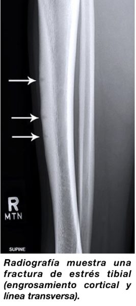 Edema óseo, la microfractura trabecular y la fractura de estrés de la ...