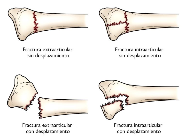 Fractura de muñeca o fractura de Colles - Synergia