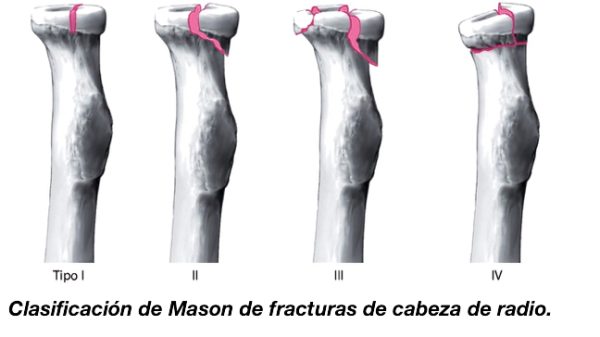 Fracturas de codo - Synergia