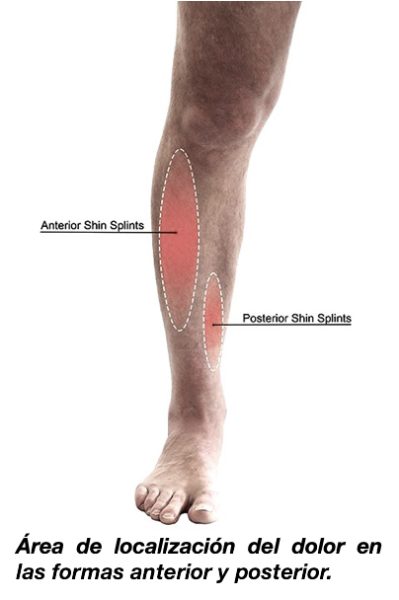 Periostitis tibial, síndrome del estrés medial de tibia o shin splint ...