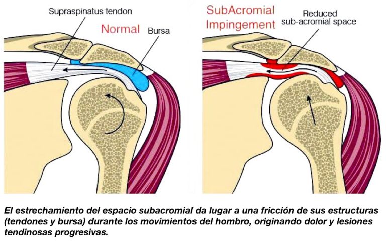 síndrome subacromial - Synergia