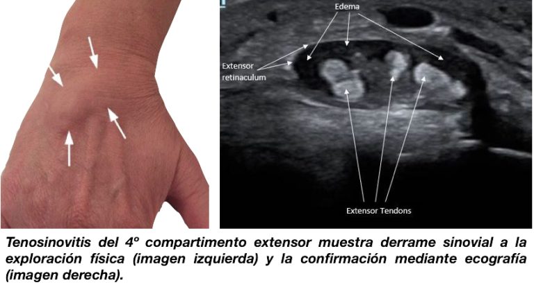 Tendinitis de los extensores de la muñeca y dedos - Synergia
