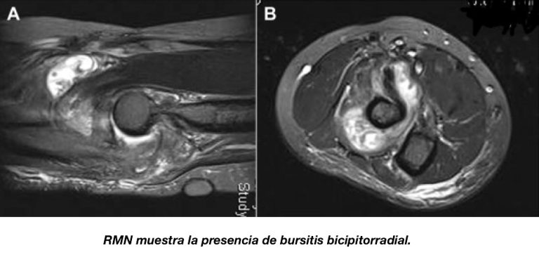 Tendinitis y rotura del tendón distal del bíceps braquial - Synergia
