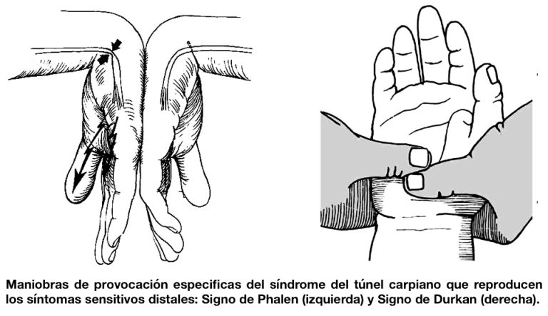 Síndrome del túnel carpiano o neuropatía del mediano - Synergia