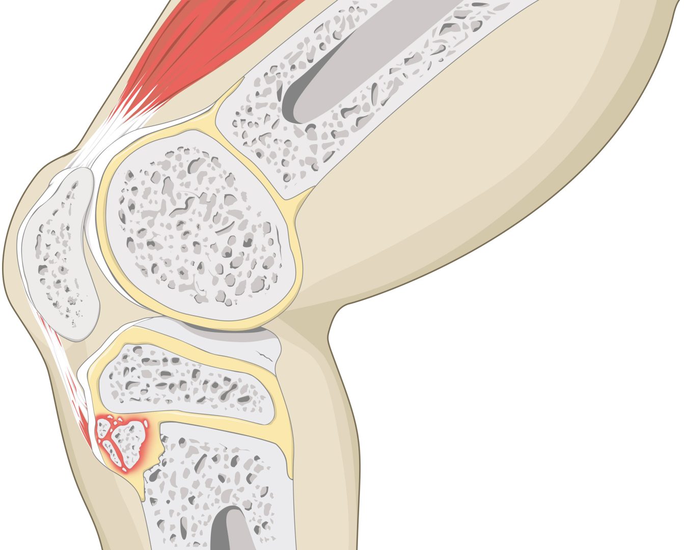 Tendinitis del rotuliano - Synergia