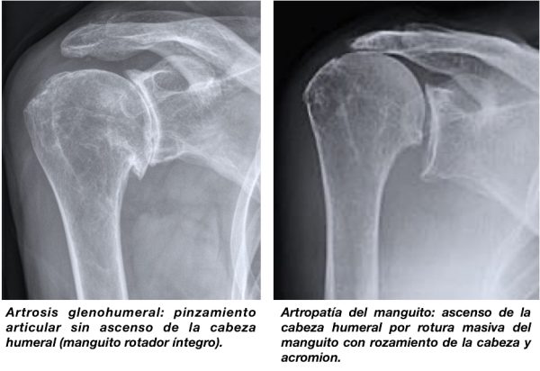 Artrosis de hombro - Synergia