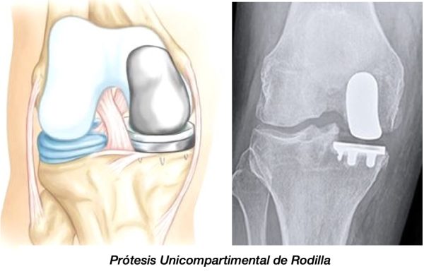 Artrosis de rodilla - Synergia