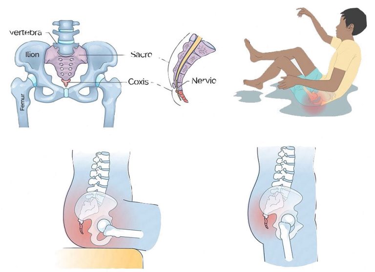 Coccigodinia o dolor en el coxis - Synergia