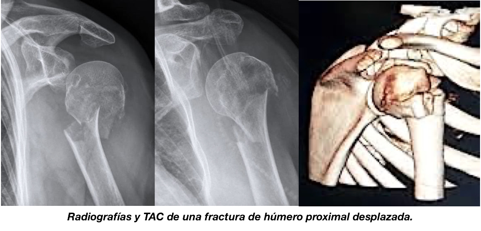 Fracturas del hombro o húmero proximal - Synergia