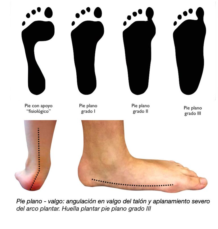 Pie plano y pie cavo - Synergia
