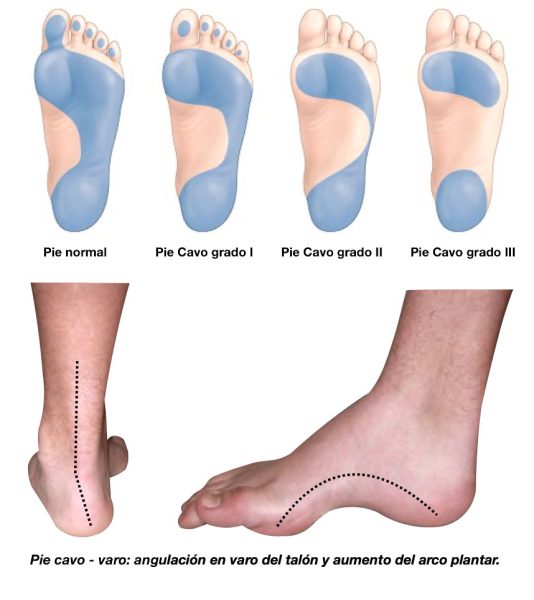Pie plano y pie cavo - Synergia