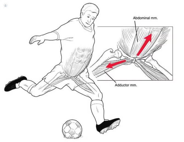 Tendinitis de los aductores - Pubalgia - Synergia