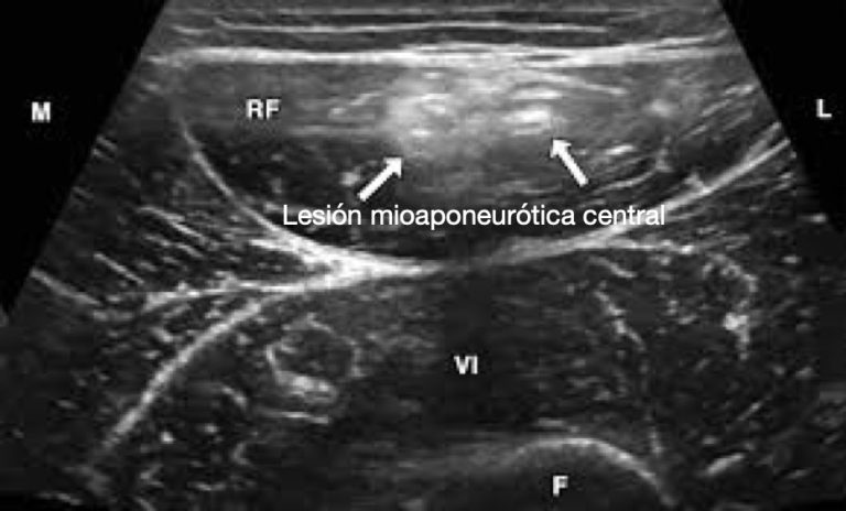 Lesiónes del recto anterior - Synergia