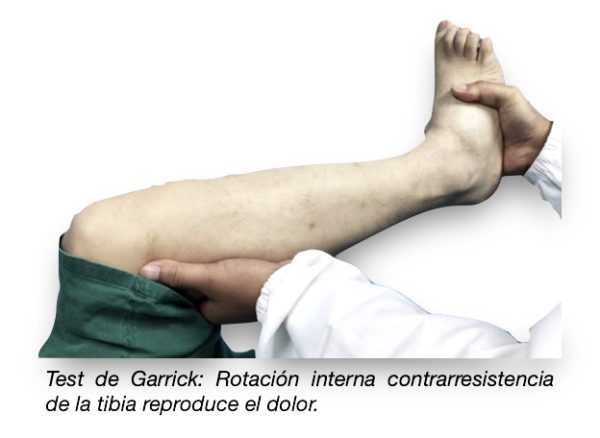 Tendinitis del poplíteo - Synergia